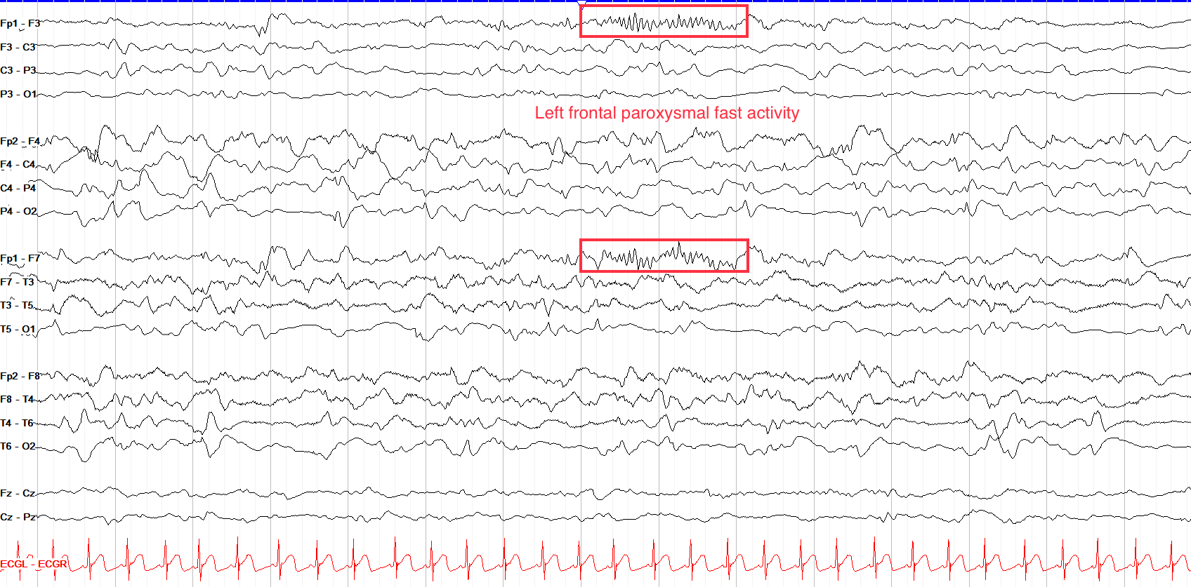 Epileptiform Activity on EEG